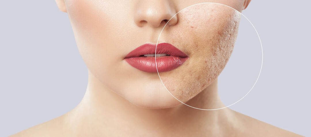 Wie schminkt man sich bei Akne? - Unreinheiten - Lombagine